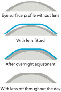 Tatum Eyecare specializes in the fitting of Scleral Lenses