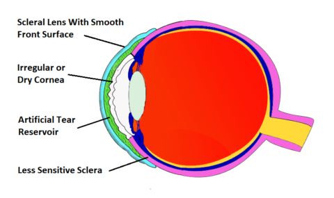 Tatum Eyecare specializes in the fitting of Scleral Lenses